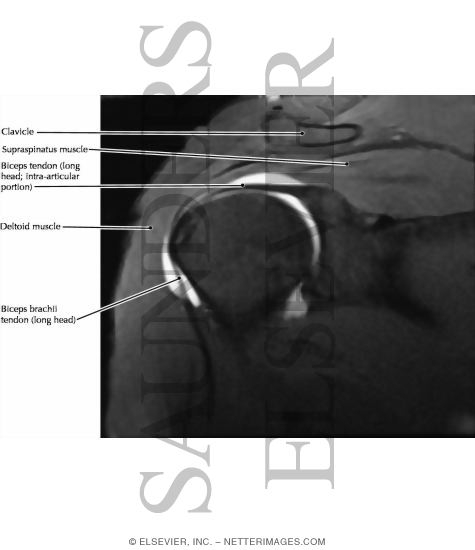 Shoulder Joint, Biceps Tendon