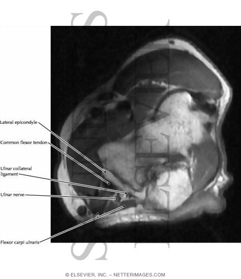 Elbow, Cubital Tunnel