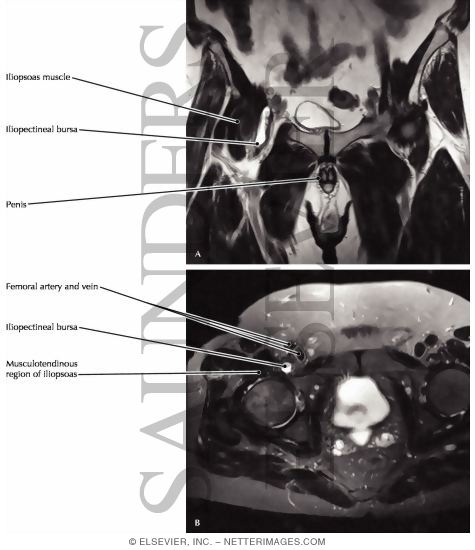 Iliopectineal Bursa
