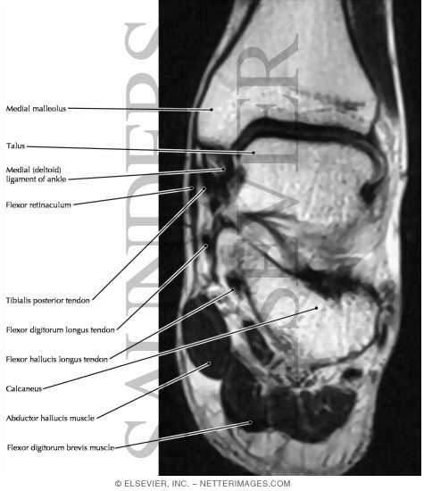 Deltoid Ligament Mri