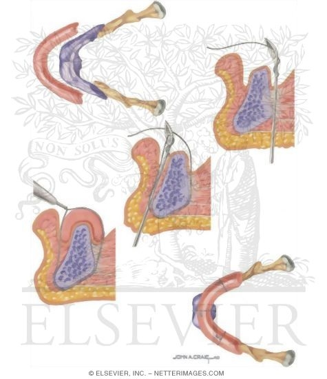 Facial Trauma: Repair of Edentulous Mandible