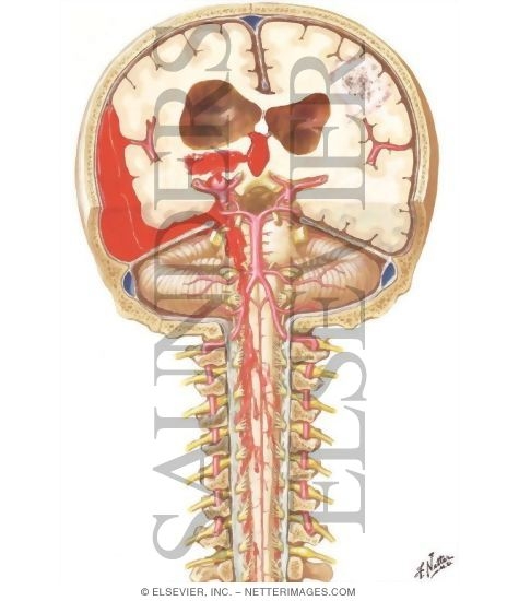 Rupture of Cerebral Aneurysms: Central Nervous System Pathology