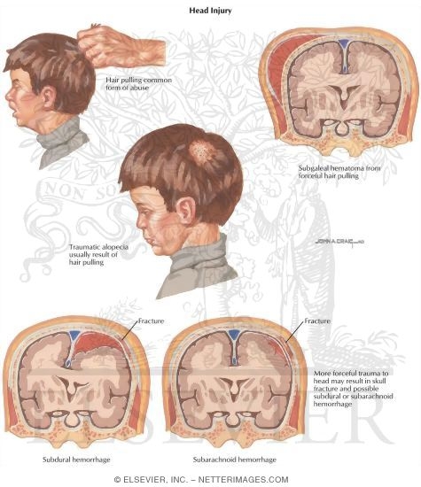 Child Abuse: Head Injury