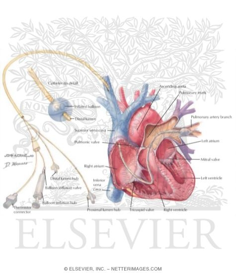 Right Heart Catheterization