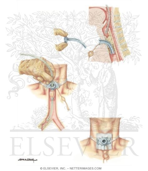 Nosocomial Infections: Tracheostomy Care