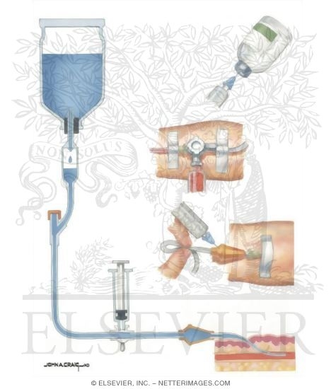 Nosocomial Infections: Sepsis Associated With Intravenous Fluid ...