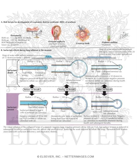 Respiratory Distress Syndrome of the Newborn