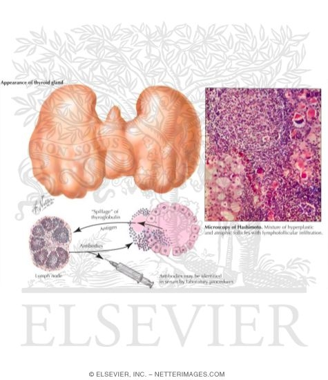 Hashimoto's Thyroiditis