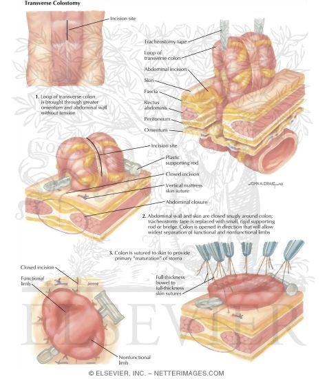 skin bridge loop colostomy