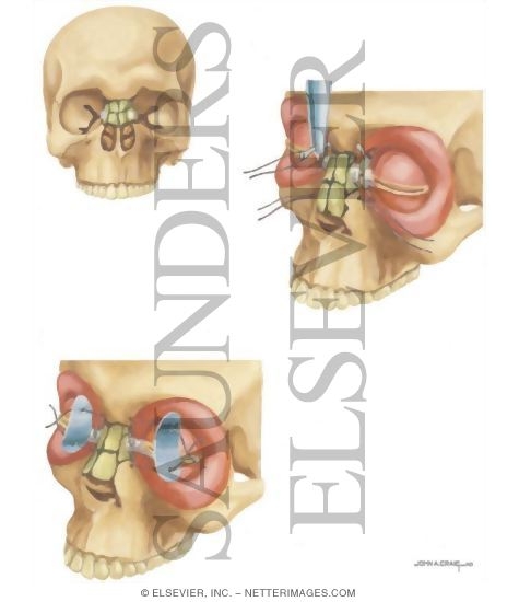 Facial Trauma: Repair of Naso-Orbital Injury