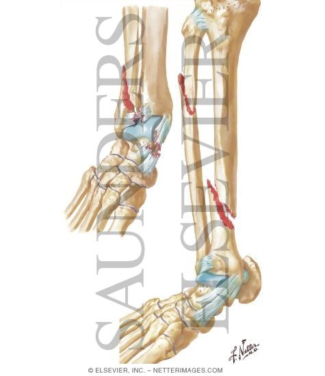 External Rotation-Abduction Fractures