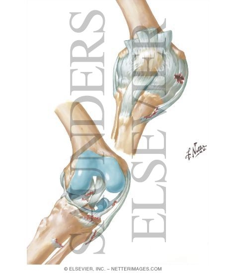 Mechanisms of Knee Joint Sprains