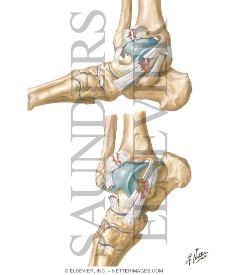 Mechanisms of Ankle Sprains