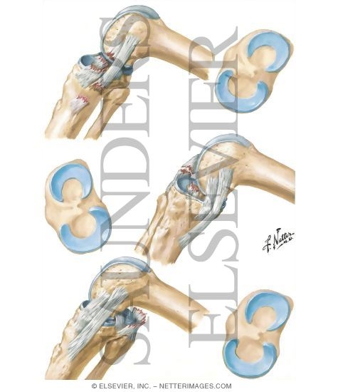 Rotatory Instabilities of the Knee