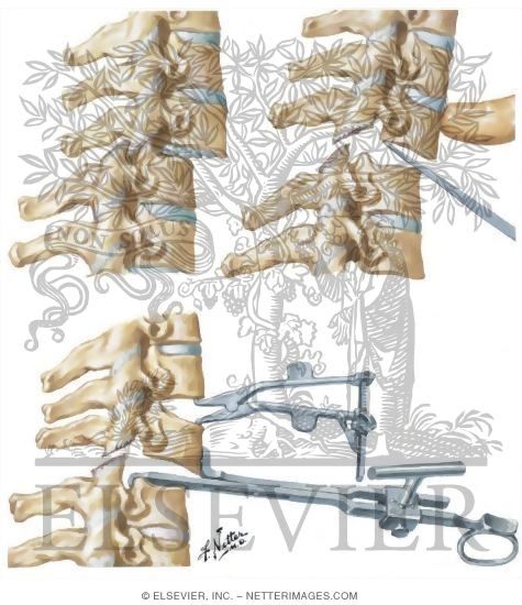 Dislocation of Cervical Spine With Locked Facets