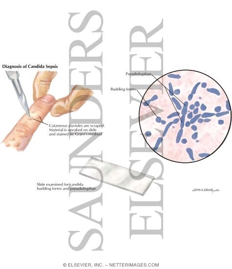 Nosocomial Infections: Diagnosis of Candida Sepsis