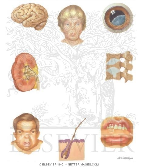 Birth Defects: Signs and Symptoms of Metabolic Disease In Childhood