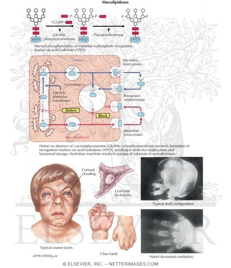 Dysmorphology: Mucolipidoses