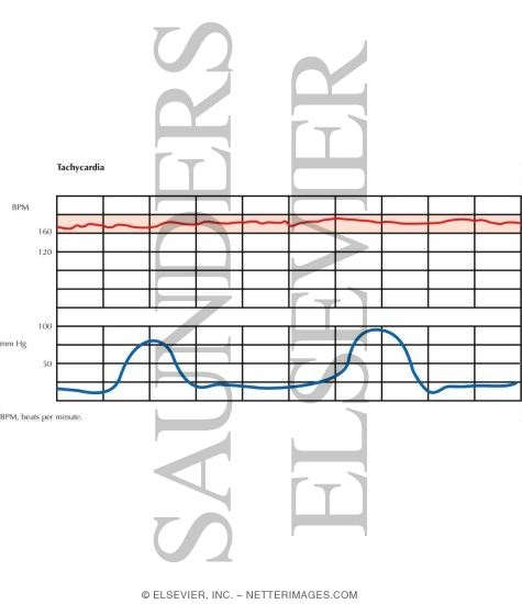 Fetal Heart Rate Testing: Tachycardia