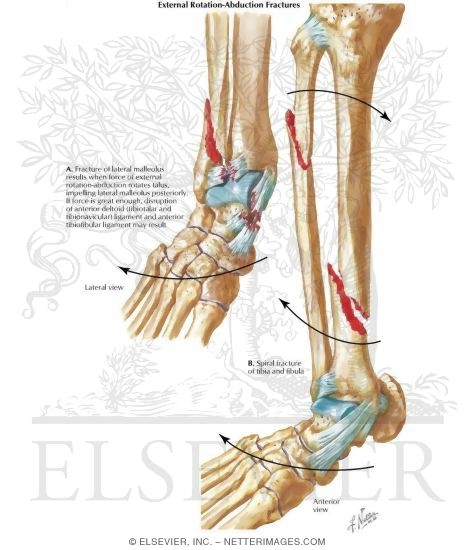 External Rotation-Abduction Fractures