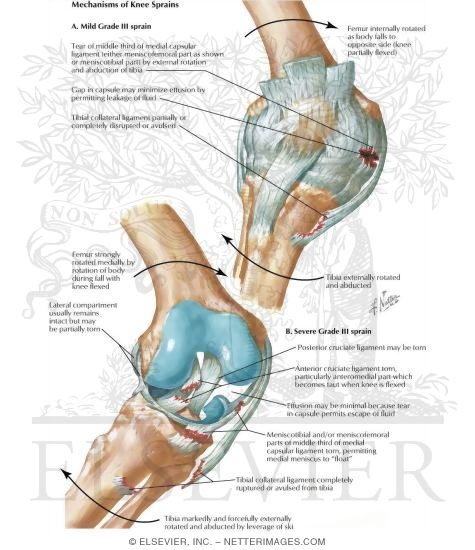Mechanisms of Knee Joint Sprains