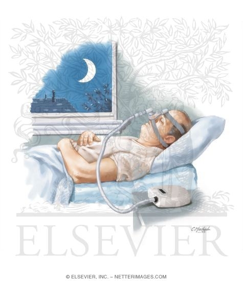 Obsructive Sleep Apnea