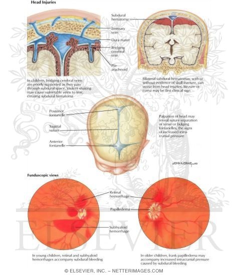 Child Abuse: Head Trauma and Head Injury