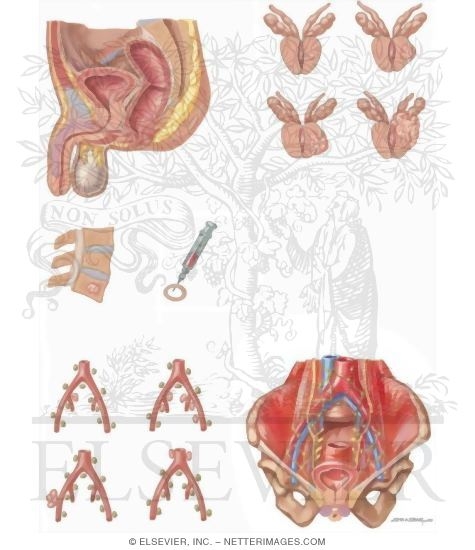 Diseases of Prostate: Clinical Staging of Prostate Cancer