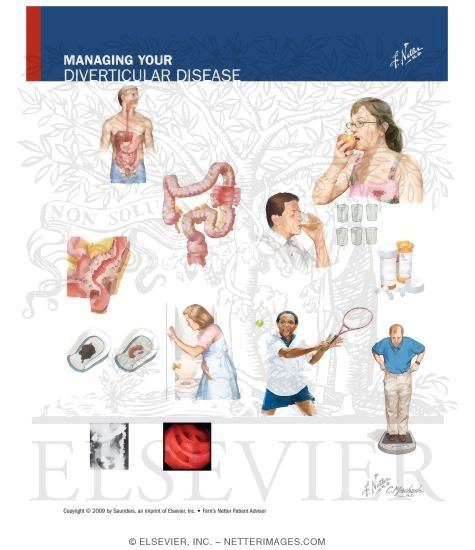 Managing Your Diverticular Disease