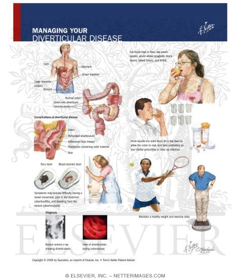 Managing Your Diverticular Disease