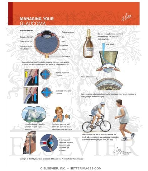 Managing Your Glaucoma