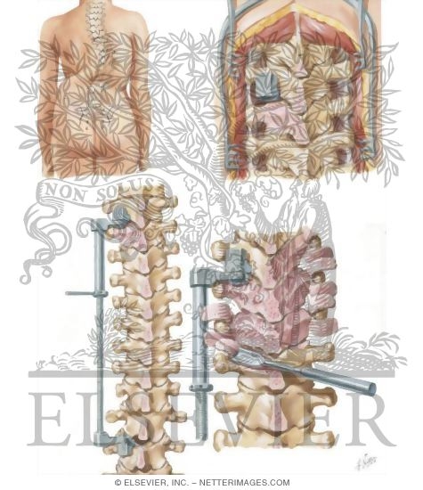 Spinal Fusion
