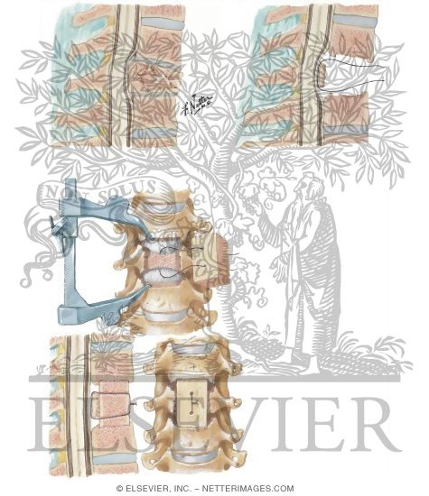 Block Fusion for Types 2 and 3 Compression Fractures of Cervical Spine