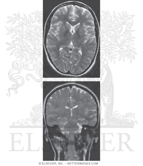 Magnetic Resonance Imaging Of The Ventricles: Axial And Coronal Views