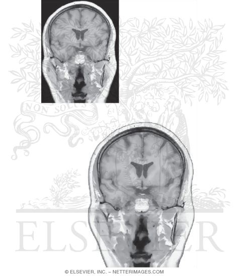 Coronal Sections Through the Forebrain: Level 3 - Anterior Commissure ...