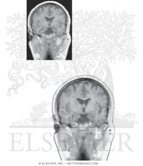 Coronal Sections Through the Forebrain: Level 4 - Amygdala, Anterior ...