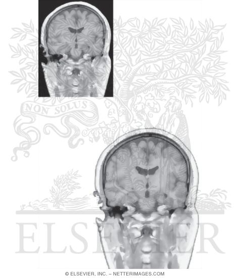 Coronal Sections Through the Forebrain: Level 5 - Mammillary Body