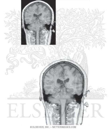 Coronal Sections Through the Forebrain: Level 8 - Geniculate Nuclei