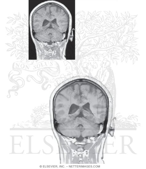 Coronal Sections Through the Forebrain: Level 10 - Splenium of Corpus ...