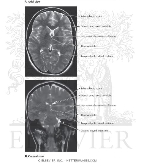 Magnetic Resonance Imaging Of The Ventricles: Axial And Coronal Views