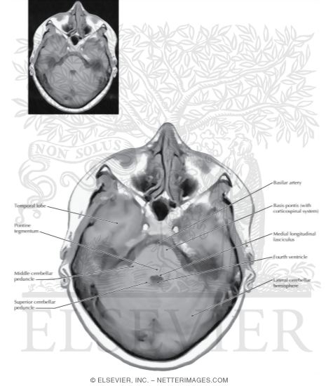Axial (Horizontal) Sections Through the Forebrain: Level 1 - Mid Pons