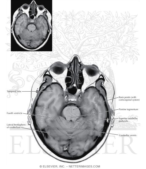 Axial (Horizontal) Sections Through the Forebrain: Level 2 - Rostral Pons