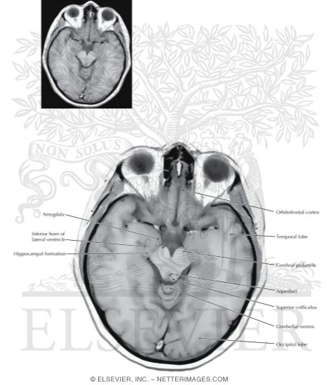 Axial (Horizontal) Sections Through the Forebrain: Level 3 - Midbrain