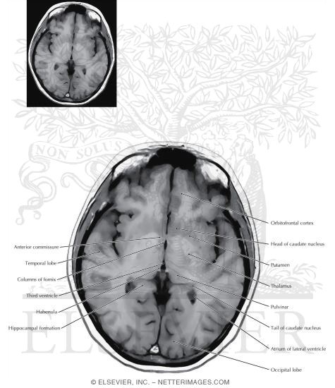 Anterior Commissure Mri