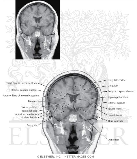 Anterior Commissure Mri