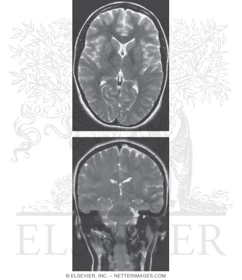 Magnetic Resonance Imaging of the Ventricles: Axial and Coronal Views
