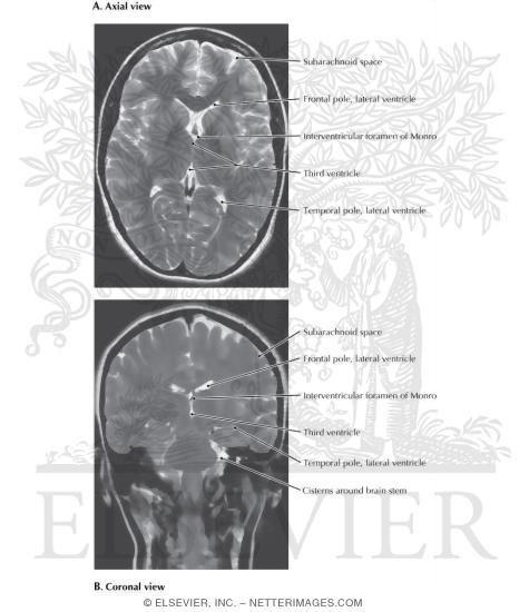 Magnetic Resonance Imaging of the Ventricles: Axial and Coronal Views