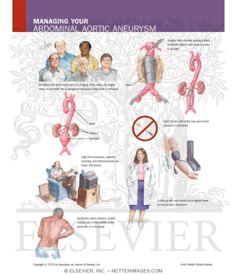 Managing Your Abdominal Aortic Aneurysm