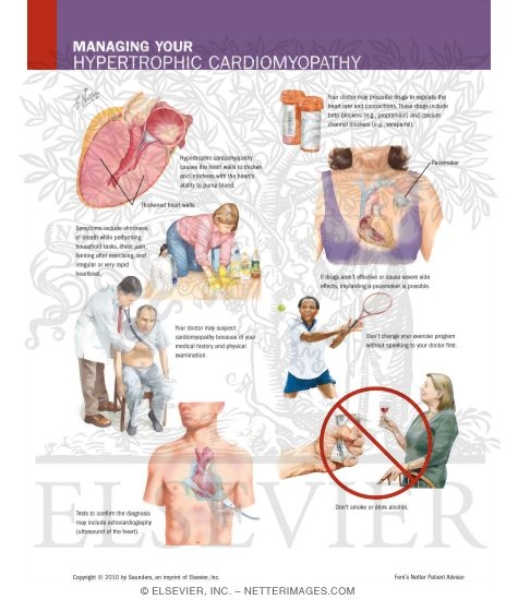 Managing Your Hypertrophic Cardiomyopathy