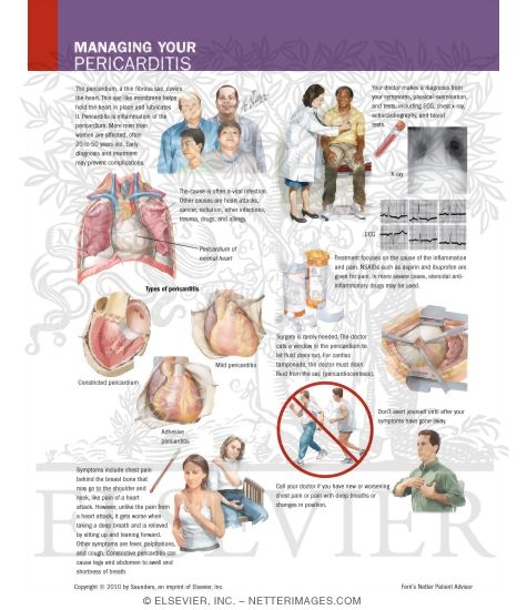 Managing Your Pericarditis